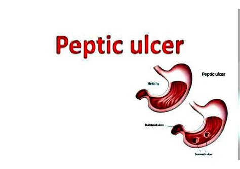 Solution Peptic Ulcers Complete Slide Studypool