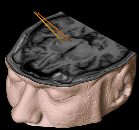 One Year Outcomes Of Multitarget Thalamic And Pallidal Deep Brain Stimulation In Unilateral