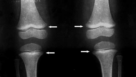 Lead Poisoning Knee X Ray At Judy Canup Blog