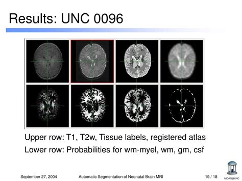 Ppt Automatic Segmentation Of Neonatal Brain Mri Powerpoint Presentation Id 735917