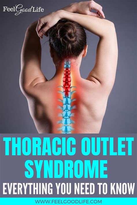Thoracic Outlet Syndrome Symptoms Artofit