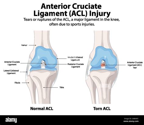 Posterior Knee Vector Vectors Hi Res Stock Photography And Images Alamy