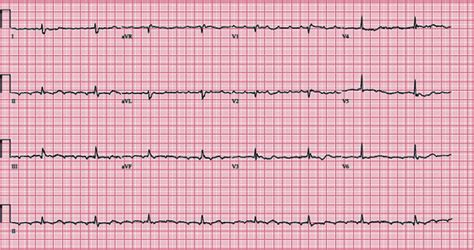 Atrial Flutter With 41 Block Download Scientific Diagram