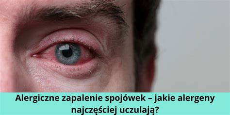 Alergiczne zapalenie spojówek objawy leczenie domowe sposoby