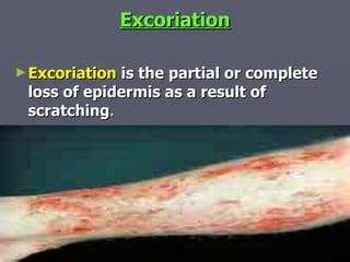 Common Skin Diseases Ppt