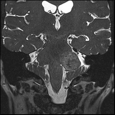 Left Vestibular Schwannoma Acoustic Neuroma And Labyrinthitis Dr