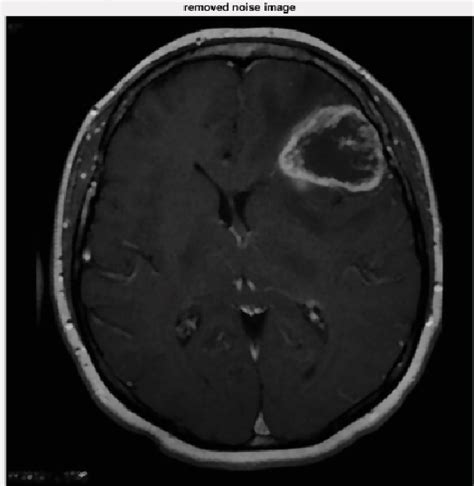 Enhanced MRI Image Using Morphological And Noise Removal Download Scientific Diagram