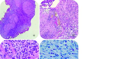 Biopsy Of The Posterior Wall Of The Urinary Bladder Compatible With