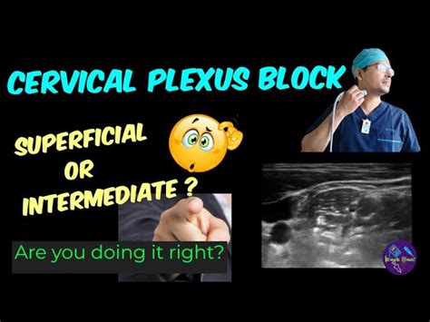 Ultrasoundguided Cervical Plexus Block Nysora The New