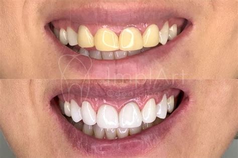 Lente de Contato Dental e Faceta em Resina Qual a Diferença
