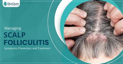 Managing Scalp Folliculitis Symptoms Prevention And Treatment