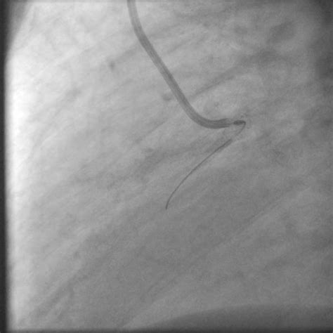 Some Guidewire Tracking Results In Each Graph The Left Image Is The