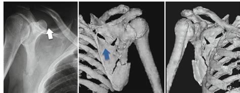 Operative Treatment Of The Scapular Body Fracture Is