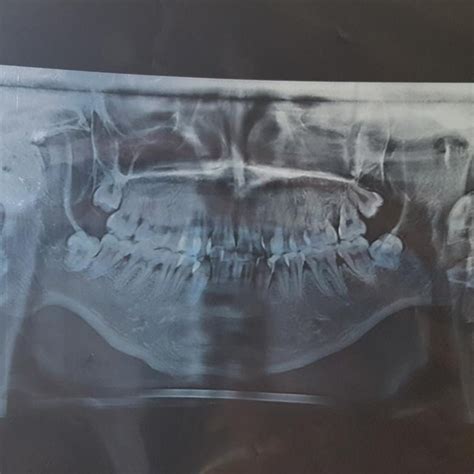 Temporomandibular Joint X Rays Showing Fusion Of Joints Download