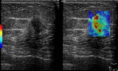 A 64 Year Old Woman With A 19 Mm Ar Positive Lesion In The Right