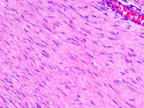 Desmoid Fibromatosis This Tumour Is Composed Of Long Fascicles Of