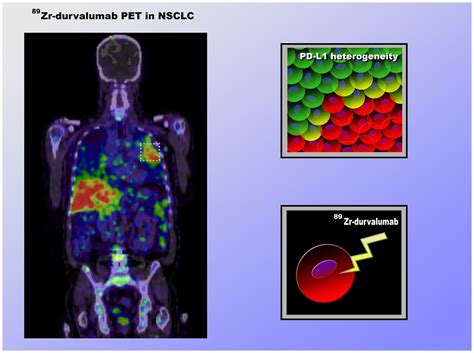 Pet Scan Cancer