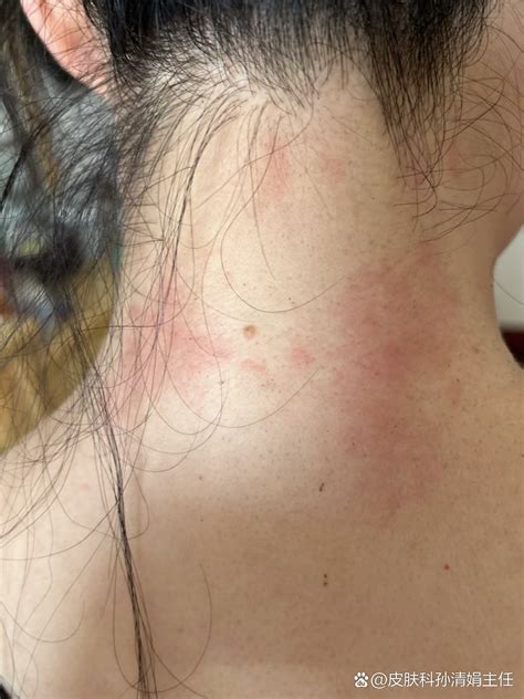 引起脖子过敏的原因