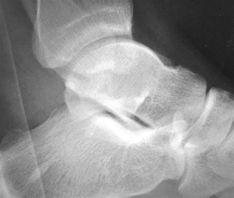 Endoscopic Os Trigonum Excision Through A Posterior Approach