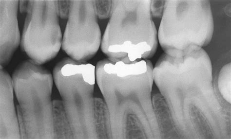 Foto De Raiox Dental Dos Dentes Com Obturações Metálicas E Mais Fotos