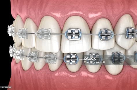치아 잇 몸에 금속 및 명확한 중괄호와 함께입니다 의학적으로 정확한 치과 3d 그림 치과교정전문의에 대한 스톡 사진 및 기타 이미지 치과교정전문의 개념 금속 Istock