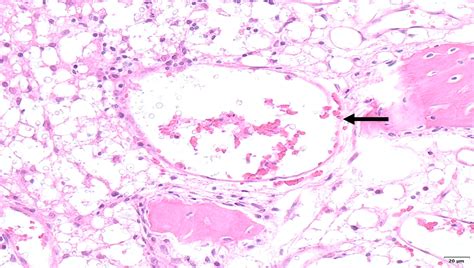 A Case Of Disseminated Cryptococcosis With Abdominal Involvement Due To