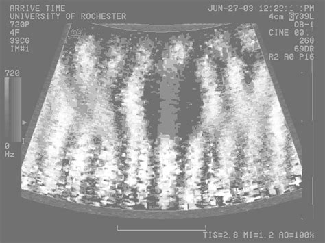 Sonoelastography Image Of Shear Wave Interference Pattern On A Zerdine