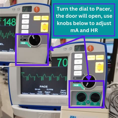 Transcutaneous Pacing Tcp Cpr Done Right Cpr Acls Bls Classes