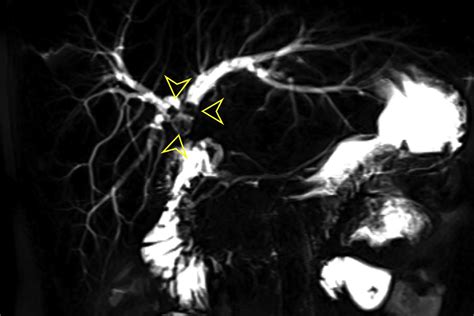 Eus Guided Hepaticogastrostomy For Management Of Cholangitis Hepatolithiasis And Anastomotic