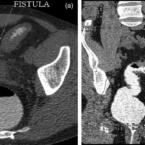 Colonoscopy Shows Inflamed Granular Mucosa Of Sigmoid Colon Download