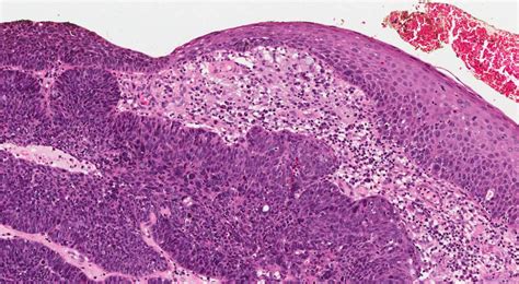 Nasopharyngeal Carcinoma Ottawa Atlas Of Pathology
