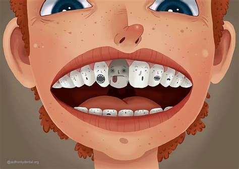 Cómo se realiza el blanqueamiento dental interno OdontoVida