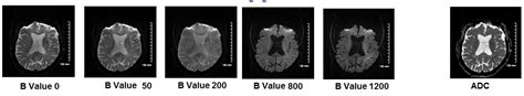 Introduction To Diffusion Tensor Imaging Dti Rite Advantage