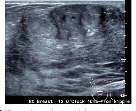 Figure 1 From Fibroadenoma In A Transgender Woman Semantic Scholar