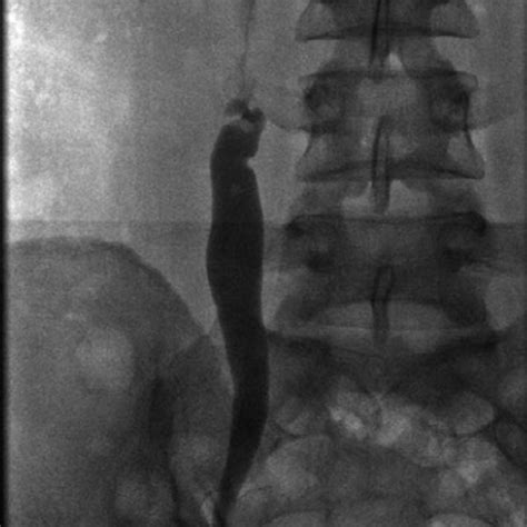 Retrograde Pyelogram Demonstrating No Extravasation Of Contrast Download Scientific Diagram
