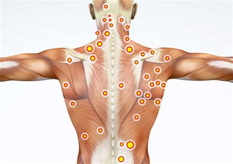 Trigger Point Injections Cleveland Medical Institute
