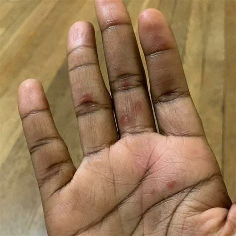 What Do Medical Conditions Look Like On Darker Skin Bbc Newsround