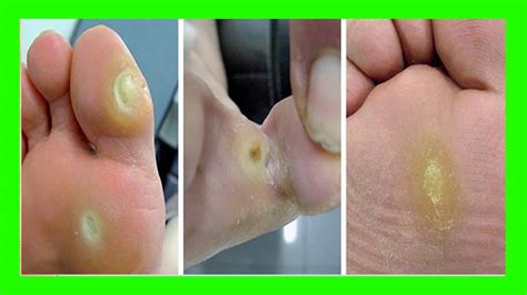 Porque Me Duele La Planta Del Pie Por QuÃ© Se Despellejan Los Pies