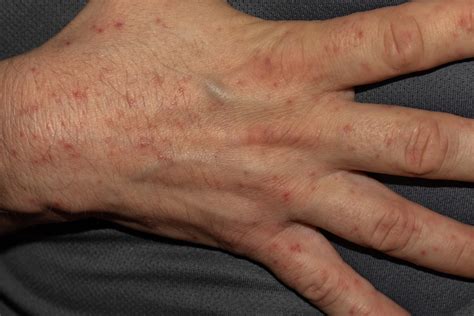 How Serious Is Scarlet Fever