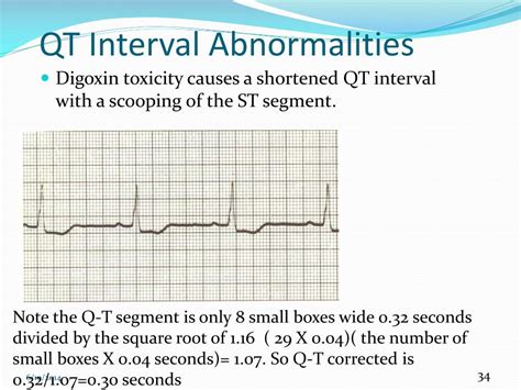 PPT Advanced ECG Interpretation PowerPoint Presentation Free Download ID 1393618
