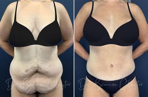 Sagging Skin After Ozempic Weight Loss Here Are Your Options Claytor Noone Plastic Surgery