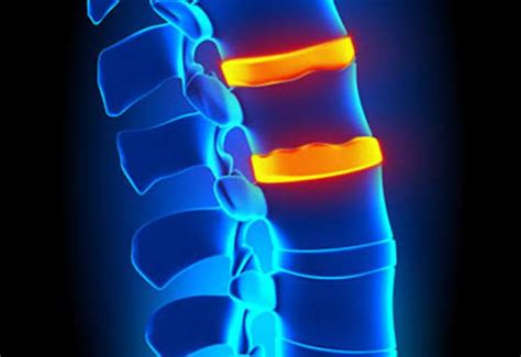Degenerative Disc Disease La Orthopedic And Pain Center
