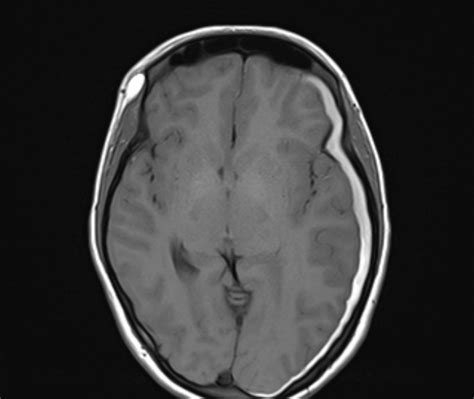 Acute Subdural Hematoma Mri