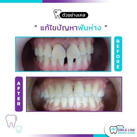 คลินิกสมายล์ไลน์รีวิว 😘 ตัวอย่างเคสจริง 👍 แก้ไขปัญหาคนไข้ “ฟันห่าง