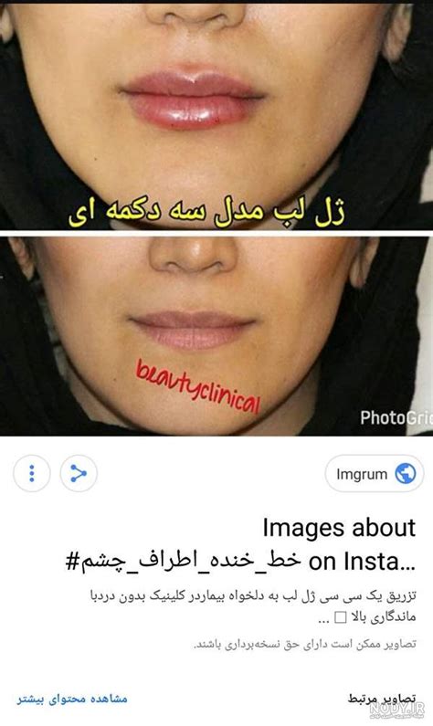 عکس تزریق یک سی سی ژل لب نی نی سایت عکس نودی