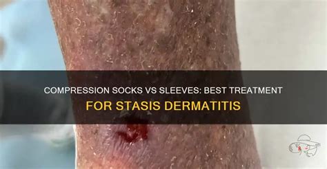 Compression Socks Vs Sleeves Best Treatment For Stasis Dermatitis