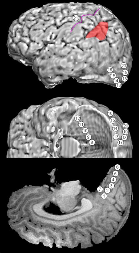 Location Of Subdural Electrodes And Resection Cavity Download
