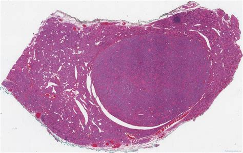 Non Invasive Follicular Thyroid Neoplasm With Papillary Like Nuclear