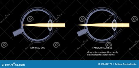 Farsightedness Structure Diagram Medical Science Vector Illustration