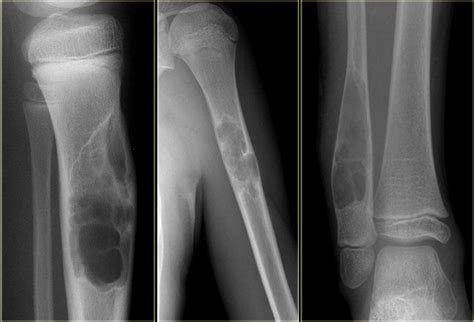 Pinterest Tumor Diagnosis Radiology Imaging